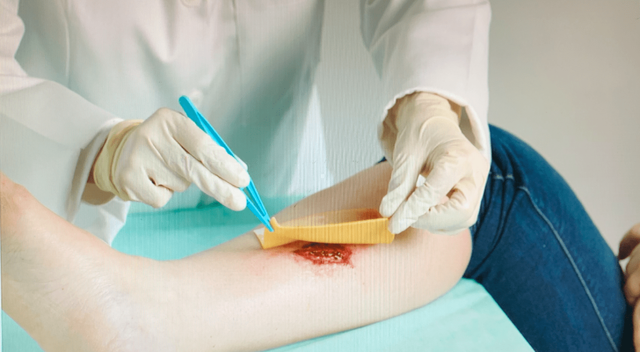 Wounds - Vivamel Medical Honey